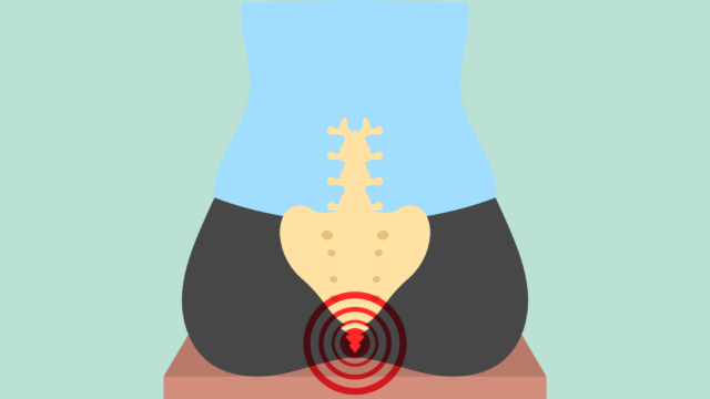 El quiste pilonidal: todo lo que necesitas saber – Unidad Cirugia Barcelona